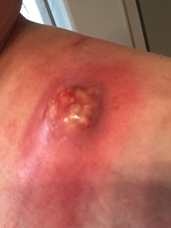 actinomyces lumpy jaw