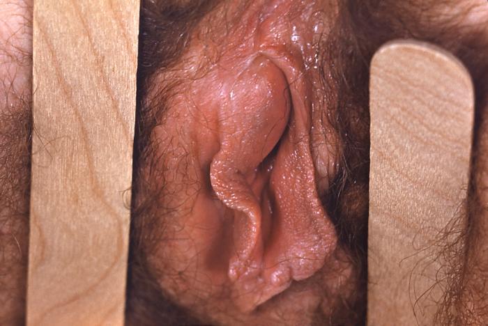 bartholinitis icd 10