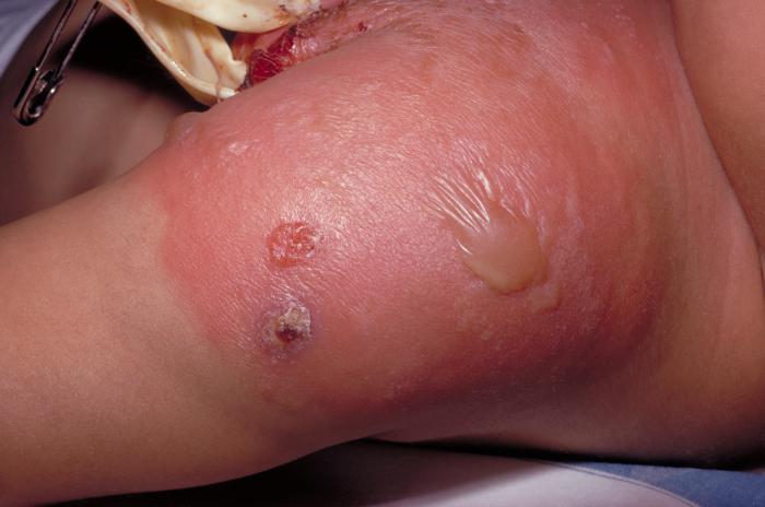bleb cellulitis