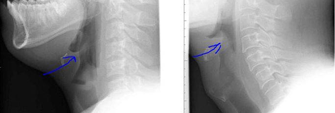 epiglottis x ray lateral