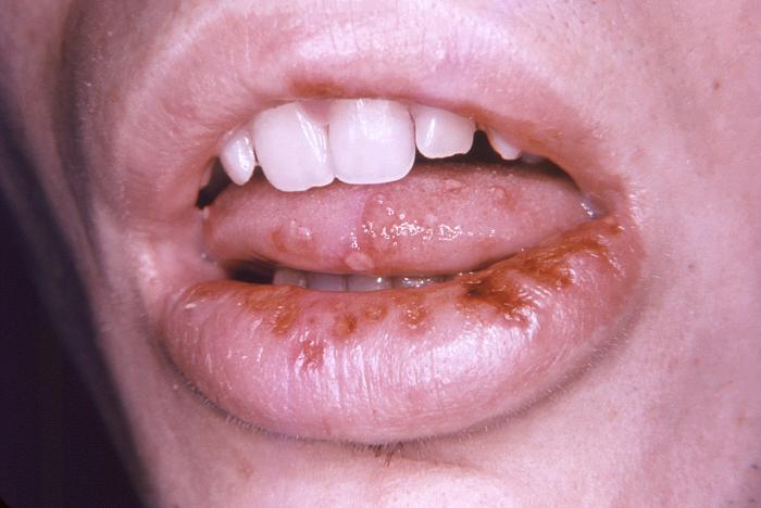 recurrent herpes simplex prophylaxis