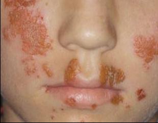 herpes simplex impetigo