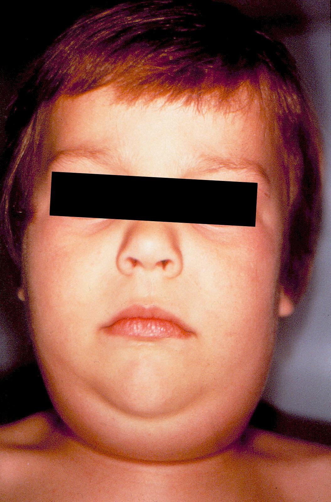 mumps in a child