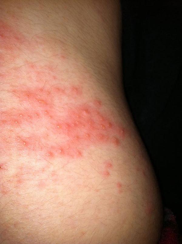 breakthrough chickenpox contagious