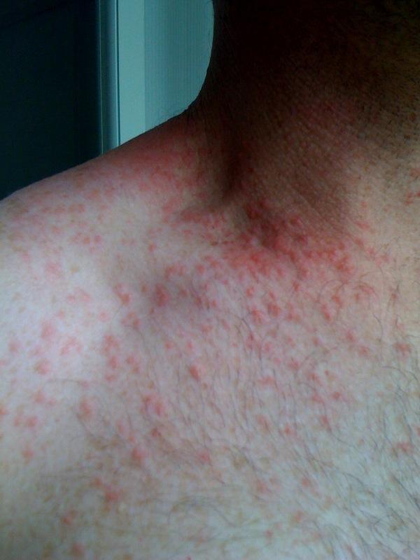 folliculitis nhs