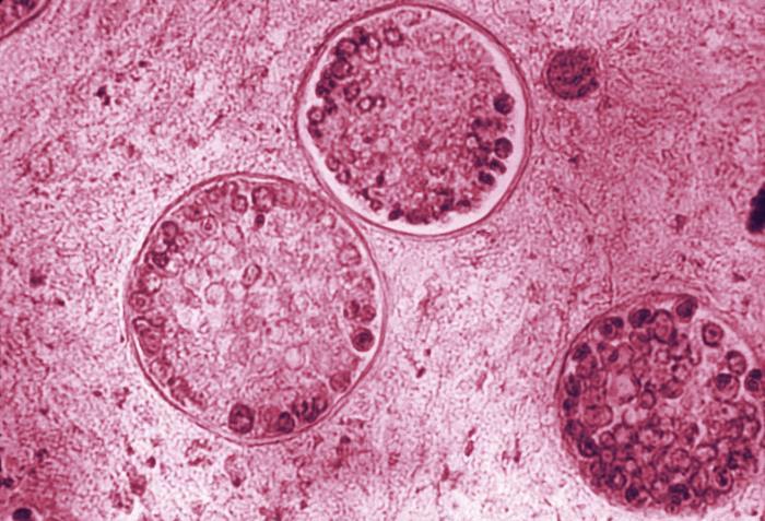 Coccidioides Arthroconidia Final Diagnosis - Case 211
