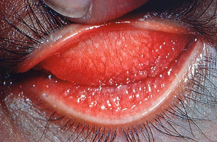 chlamydia trachomatis eye