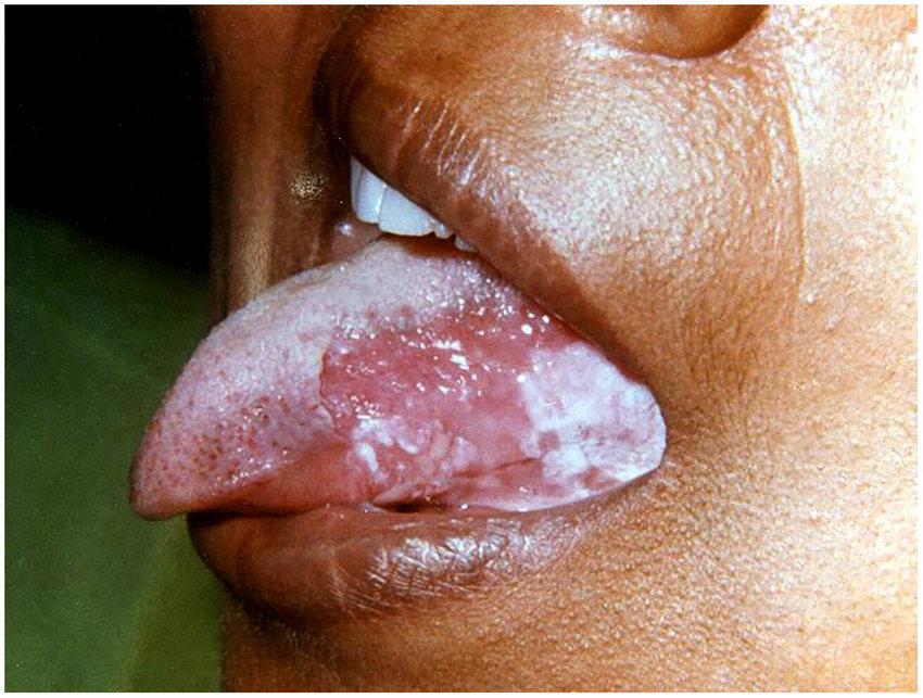 chronic hyperplastic candidiasis malignancy