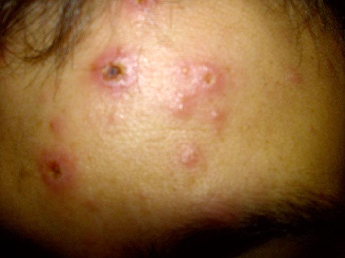 breakthrough chickenpox duration